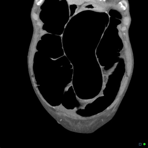 Radiopaedia Case Sigmoid Volvulus Failed Rectal Tube Decompression Id