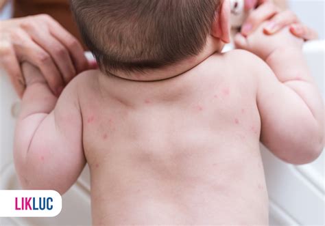 Roséola Infantil O Que é Causas Tratamentos E Mais
