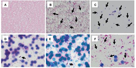 Evaluation Of Blood Culture Broths With Lysis Buffer To Directly Ident IDR