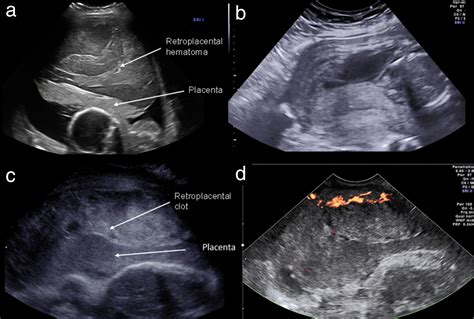 Placental Abruption Ultrasound Diagnosis