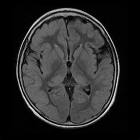 Neuroanatomy Glossary Anoxic Encephalopathy Ditki Medical