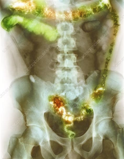 Ulcerative Colitis X Ray Stock Image C010 3506 Science Photo Library