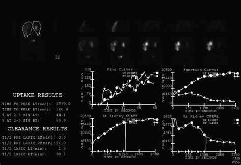 7 Diuretic Renogram With Mag3 Demonstrating Flat Drainage After Download Scientific Diagram