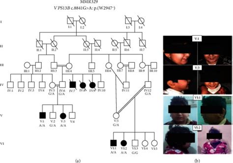 A Novel Variant In Vps13b Underlying Cohen Syndrome Pmc