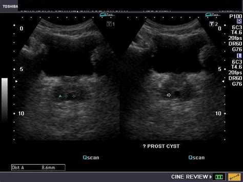 Cochinblogs Trus Transrectal Ultrasound Of Prostate Utricle Cyst