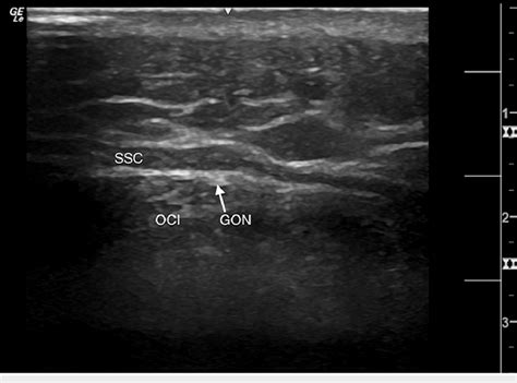 Left Sided Greater Occipital Nerve Gon Seen With Highfrequency Linear Download Scientific