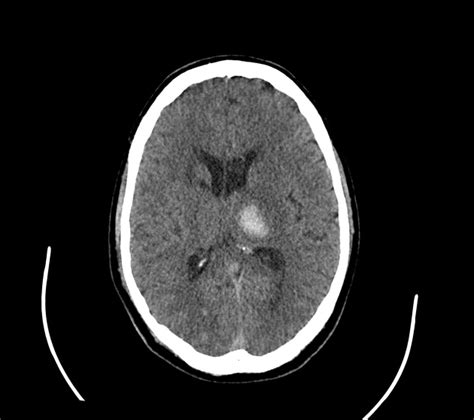 Intracerebral Hemorrhage Ct