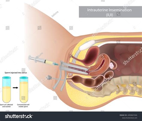 Human Insemination
