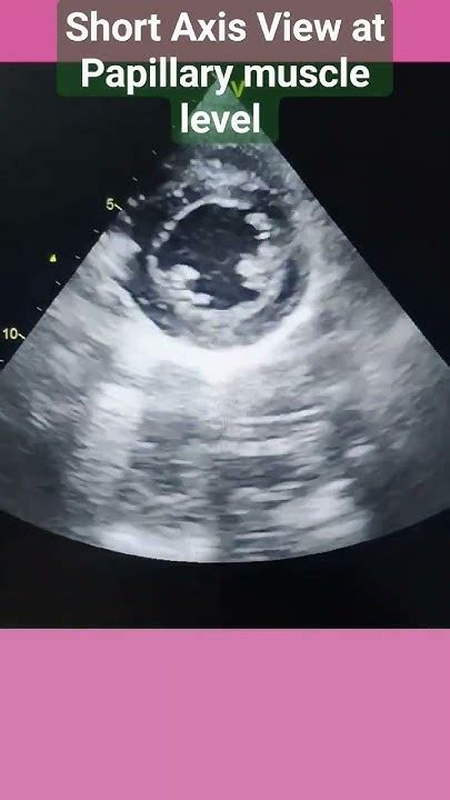 Parasternal Short Axis View Echo L Sax View At Papillary Muscle Level L