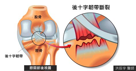 《個案分享》後十字韌帶撕裂傷，prp 注射後順利恢復 立澄診所