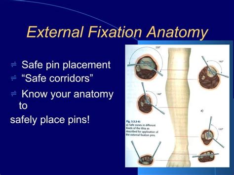 External Fixation Indications And Techniques Pptx