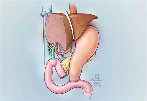 Case Study Patient Undergoing Whipple After Liver Transplant