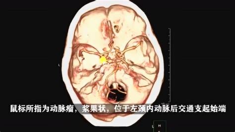 脑动脉瘤破裂出血，微创治疗之介入栓塞术高清1080p在线观看平台腾讯视频