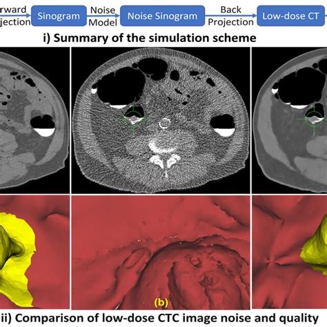 A Patient With A 1 7 Cm Pedunculated Polyp In The Sigmoid Colon A Download Scientific