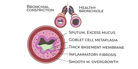Physician Assistant Pa Glossary Asthma For Pa Ditki Medical And Biological Sciences