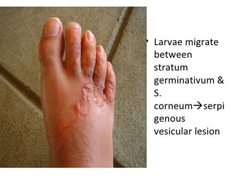 Do Hookworms Live In The Ground At Alana Toomey Blog