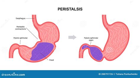 Gastroparesis Anatomical Poster Vector Illustration