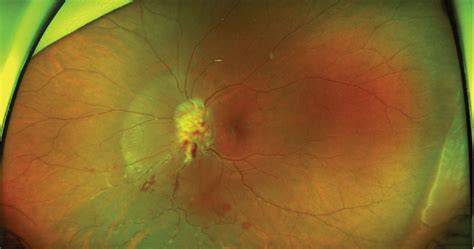 Sarcoidosis Uveitis Fewer Ocular Sarcoidosis Symptoms Seen In Older