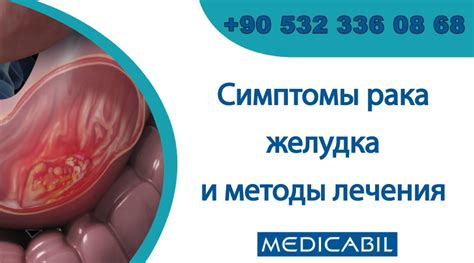 Blog Симптомы рака желудка и методы лечения