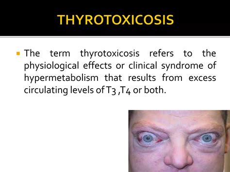 Hyperthyroidism Pptx