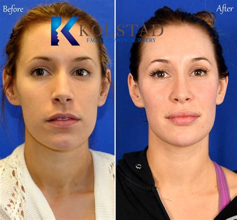 Wide Bridge Nose Job Before And After Gallery 1 Dr Kolstad San Diego Facial Plastic Surgeon