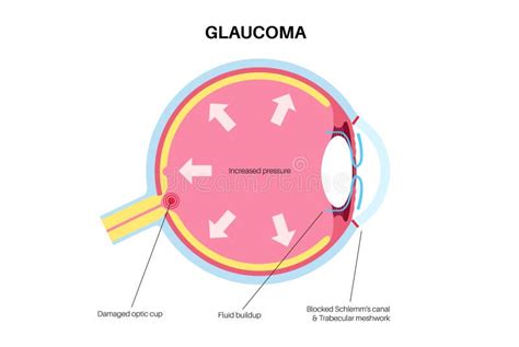 Glaucoma Eye Pressure Stock Vector Illustration Of Cornea 331243855