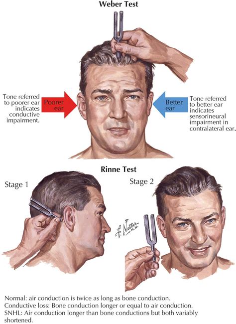 Cranial Nerve Viii Auditory And Vestibular Clinical Tree