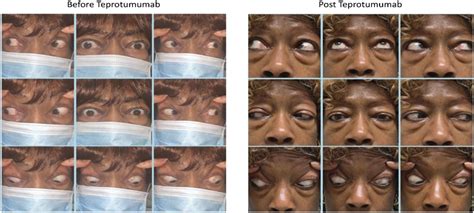 A Paradigm Shift In The Management Of Thyroid Eye Disease Ho Journal Of Neuro Ophthalmology