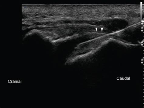 Ultrasound Guided Caudal Injection Sifsof