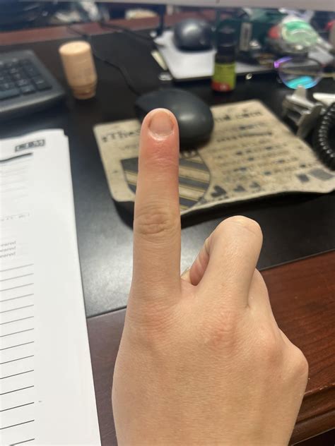 Random Finger Swelling R Medical Advice