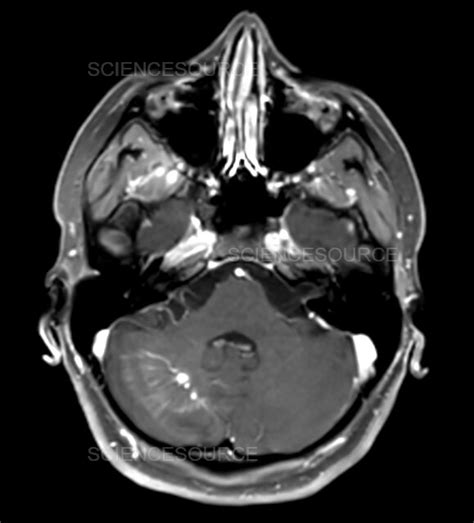 Photograph Large Developmental Venous Anomaly Mr Science Source Images