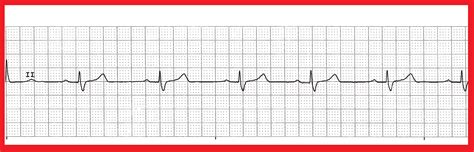 Float Nurse Practice Ekg Strips 349