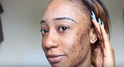 ჯადოსნური მაკიაჟი ვერ წარმოიდგენთ ამის დამალვა მაკიაჟით თუ შესაძლებელი იქნებოდა ვიდეო