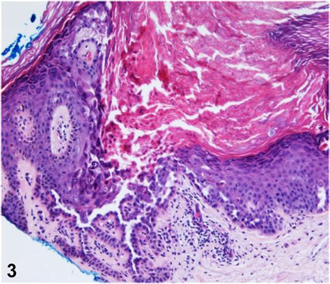 Zosteriform Eruption In An Adult Male Jaad Case Reports