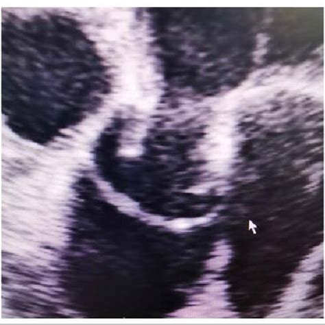 Image Of A Thick Intimal Flap Apical Section 5 Cavity Centered On The