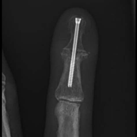 Arthritis Finger Operation At Jody Featherston Blog