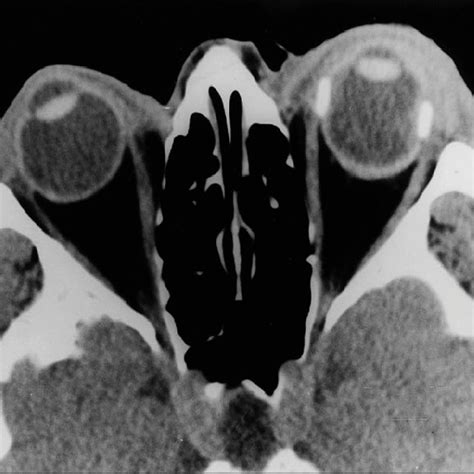 Diffuse Scleral Thickening Of The Left Eye After Scleral Buckle Case