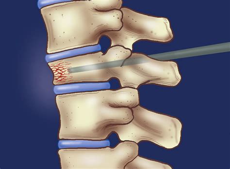 Types Of Spinal Fractures Spine Blogs
