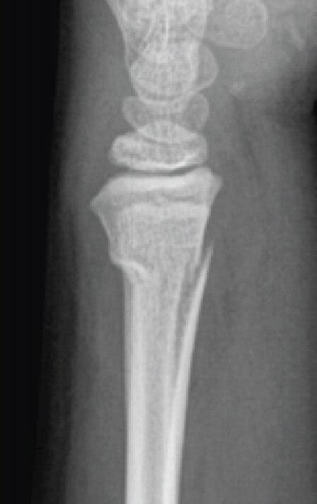 Three Metaphyseal Fracture Patterns A Buckle B Greenstick C Download Scientific