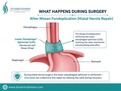 Why No Chocolate After Hiatal Hernia Surgery