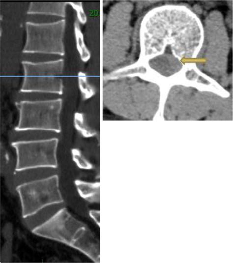 Intervertebral Disc Calcification Radiology At Harry Reese Blog