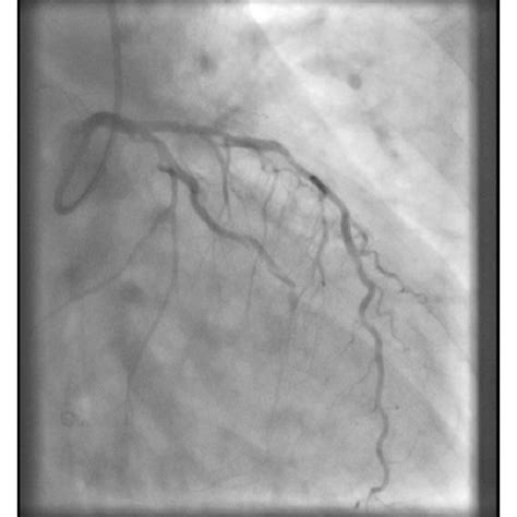 Type B Dissection Of Proximal LCX Download Scientific Diagram