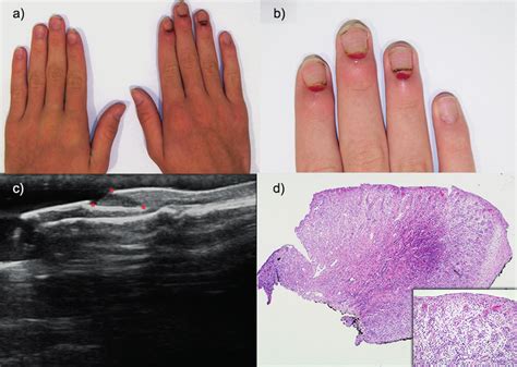 A Unilateral Pyogenic Granulomas On The Proximal Nail Fold Of The 2