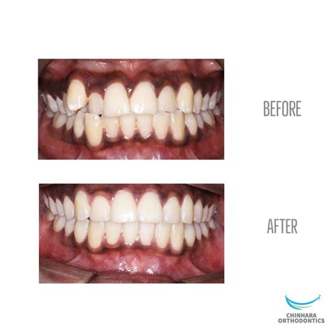 Yaeba Teeth Before And After