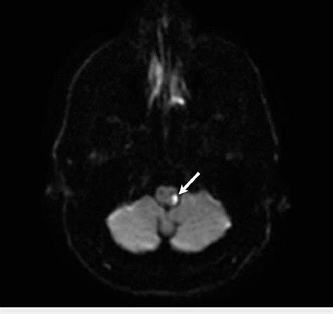 Diffusion Weighted Mri Of The Brain Without Contrast Showing A Small