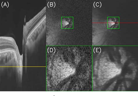 Figure 4 From Deep Learning Based Noise Reduction Method For Automatic 3d Segmentation Of The