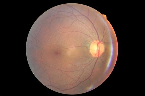 Diabetic Retinopathy Classification Dataset By Hackboats