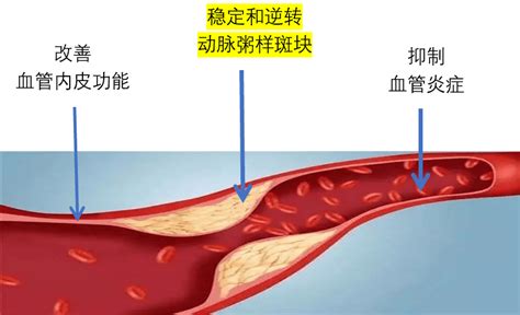 他汀到底该吃多久？这篇文章说明白了！胆固醇降低患者