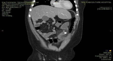 Ct Showing Left Sided Appendicitis With Appendicolith Download