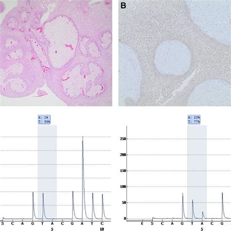 Histopathological And Molecular Genetic Findings Papillary Download Scientific Diagram